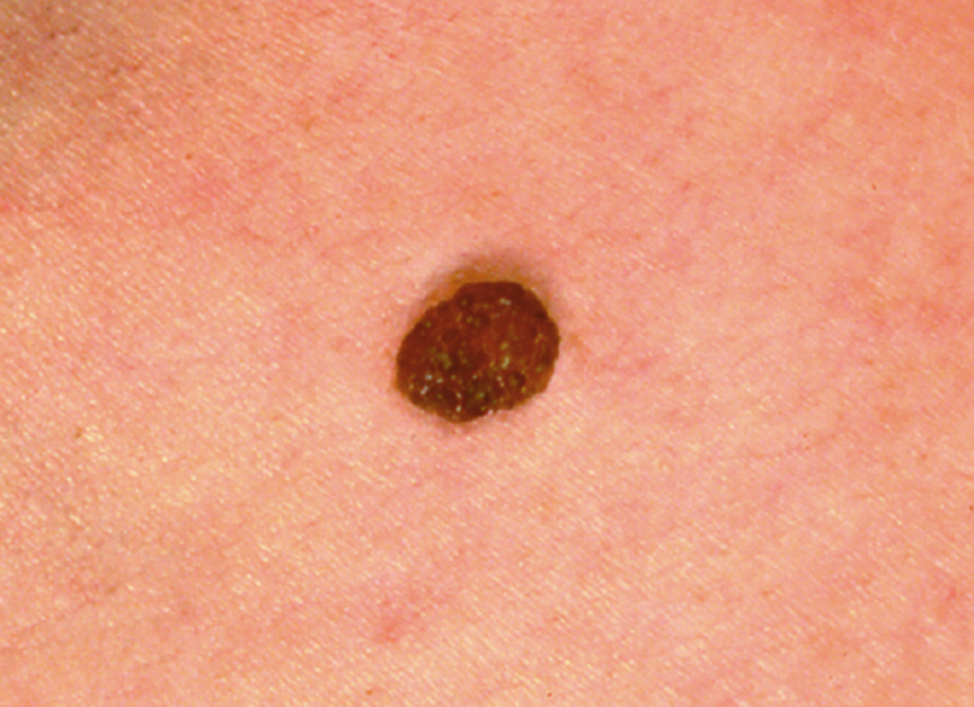 Do you know your ABCDEs? - Cayman Health and Wellness