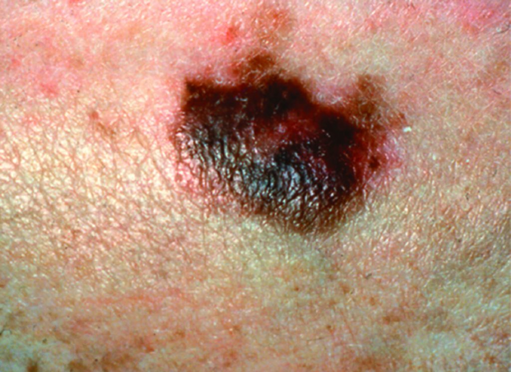 Do you know your ABCDEs? - Cayman Health and Wellness