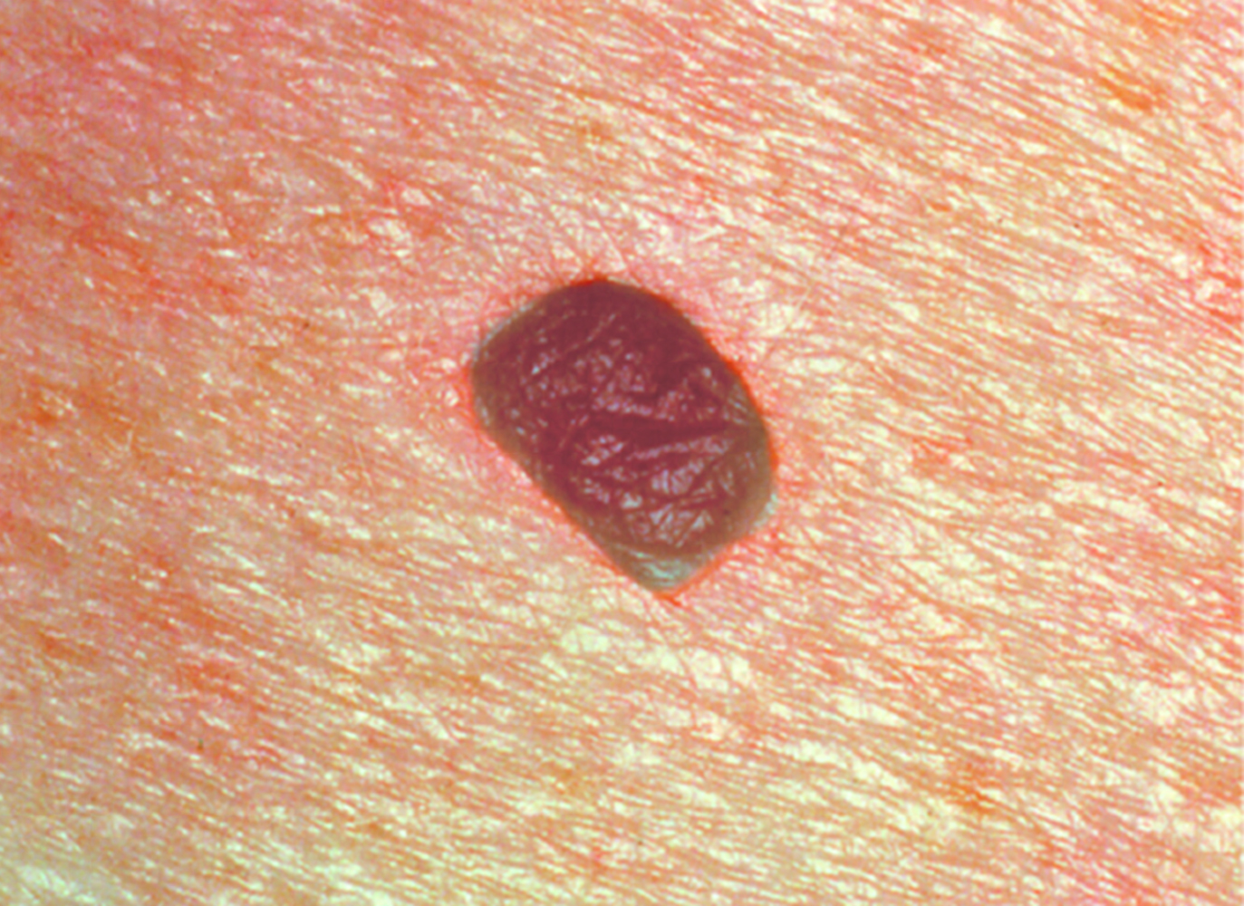 Do you know your ABCDEs? - Cayman Health and Wellness